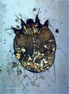 Scabies – RefHelp