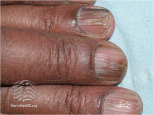 Common Nail Disorders – RefHelp