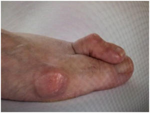 Lesser Toe Deformities – RefHelp