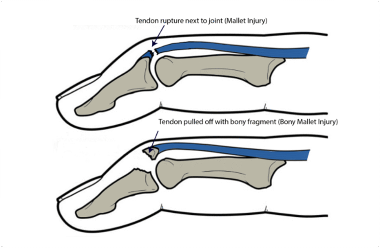 Mallet Finger Injury – RefHelp