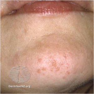 Viral Warts – RefHelp