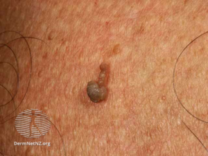Benign Lesion (Skin Tags, Warts, Moles, Dermatofibroma) – RefHelp