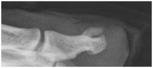Subungal Exostosis – RefHelp