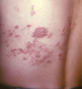 Recurrent Vesicular Rash – RefHelp
